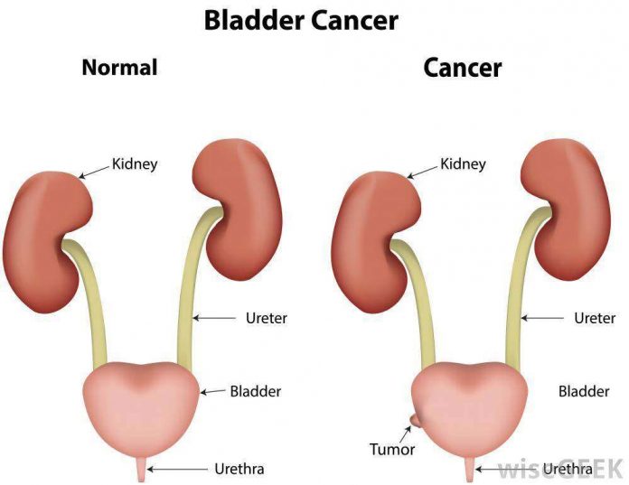 Bladder Diagram
