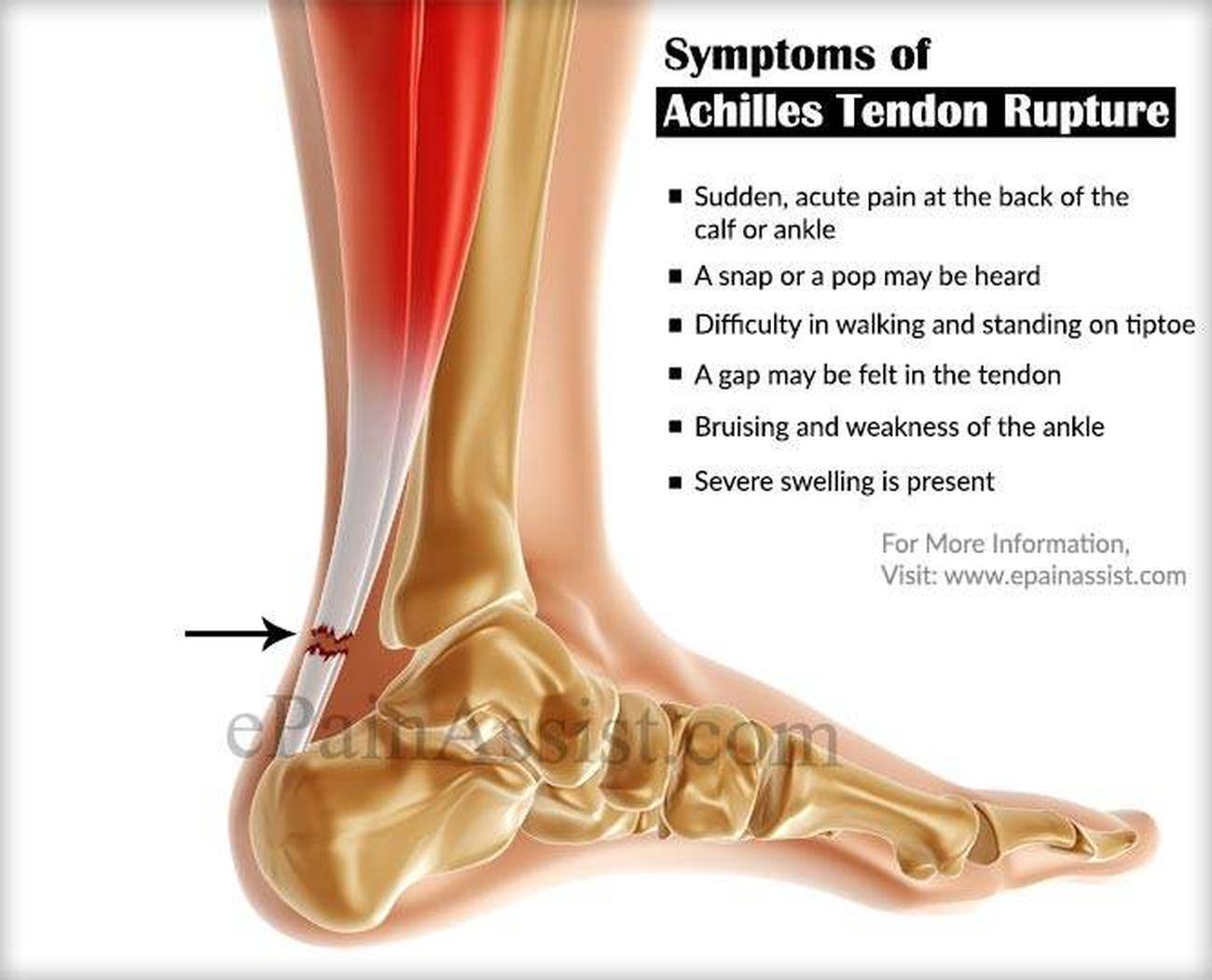 Pictures Of Tendonitis Cam Sex Video