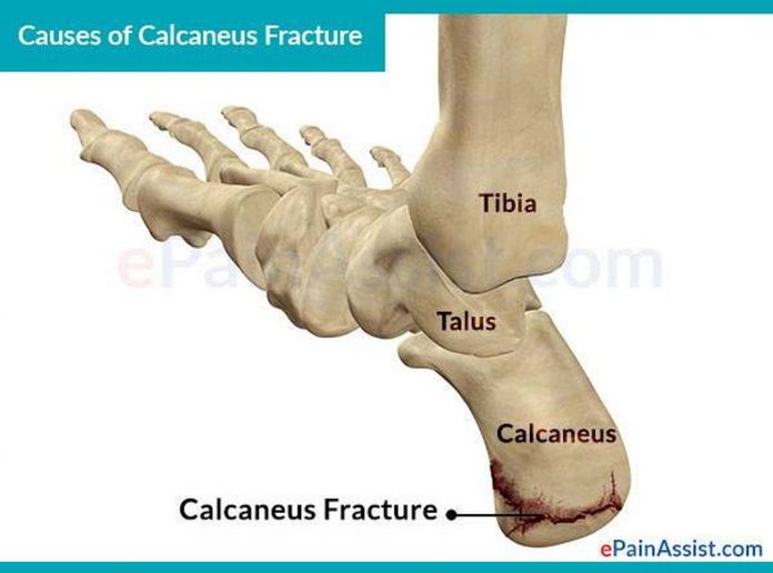 Pictures Of Calcaneus