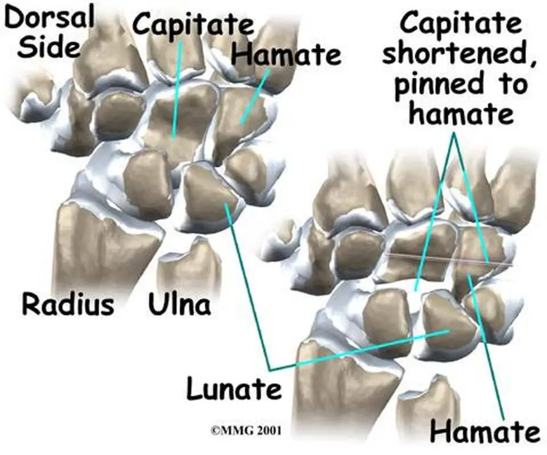 Pictures Of Capitate