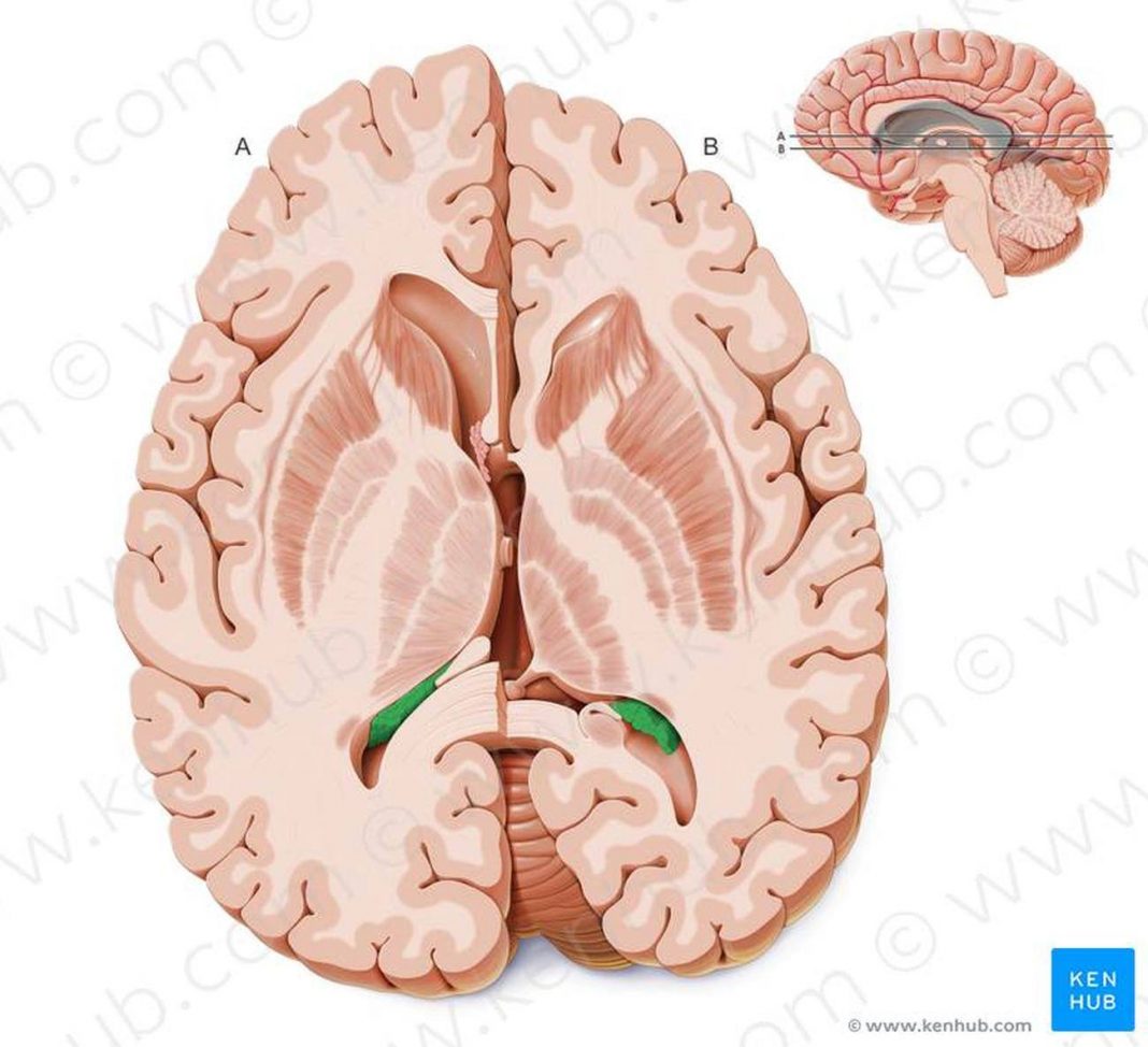 Pictures Of Choroid Plexus