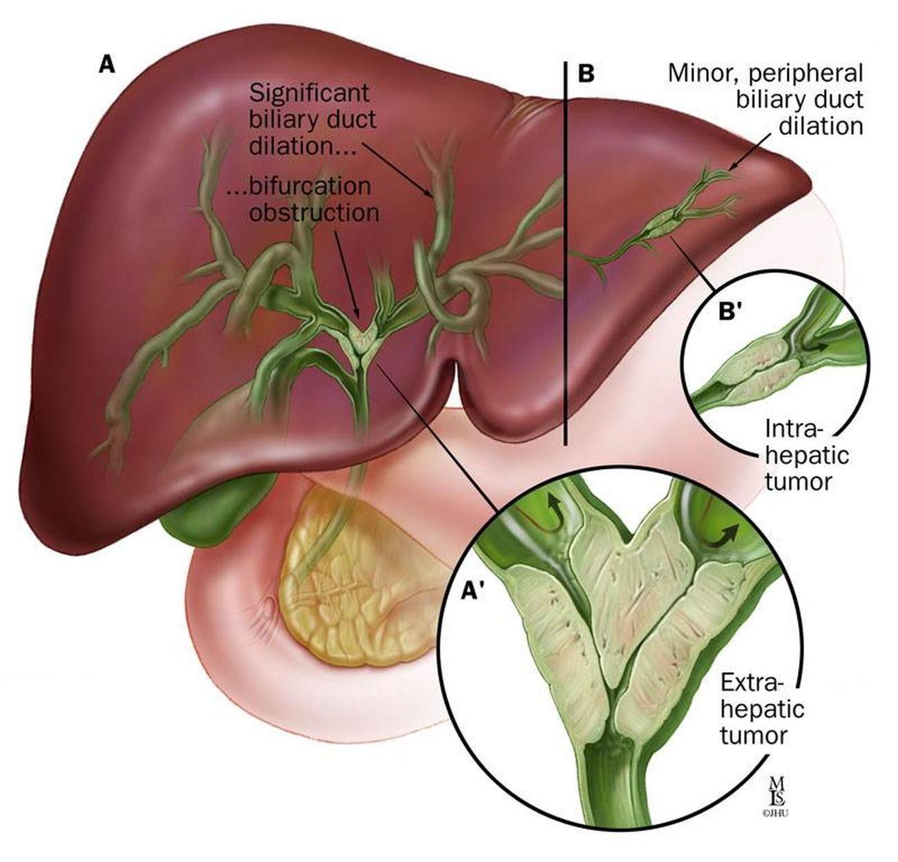 Pictures Of Bile Duct