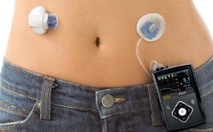 How Diabetes Pumps Work
